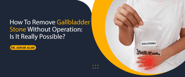 Remove Gallbladder Stone Without Operation - Dr. Azhar Alam